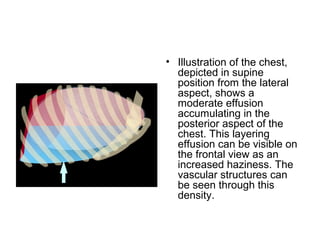 Pleural diseases chest radiology part1 | PPT