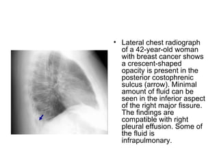 Pleural diseases chest radiology part1 | PPT