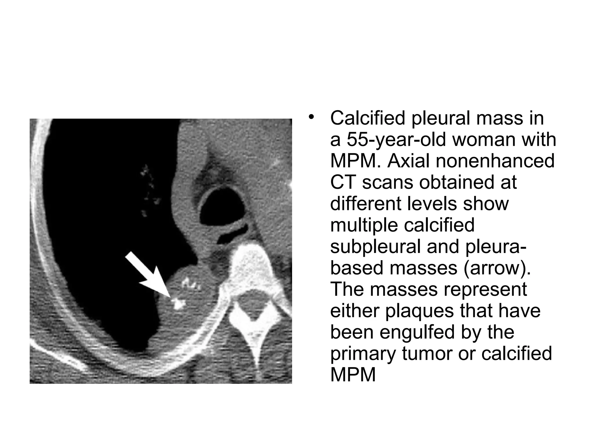 Pleural diseases chest radiology part 2 | PPT