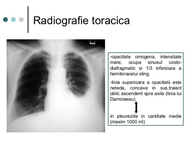 Pleurezii - Dr Adina Turcanu
