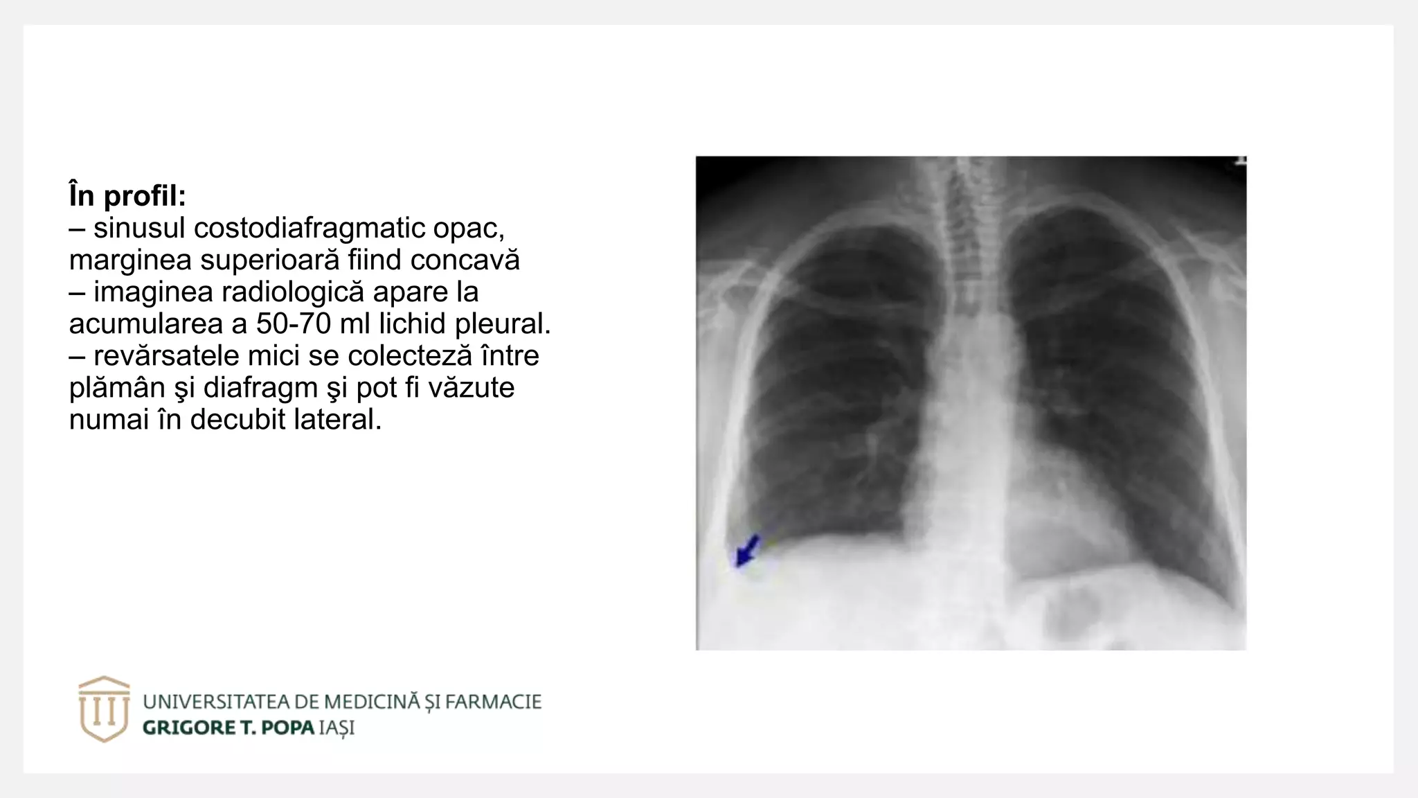 Pleureziile (final) | PPTX