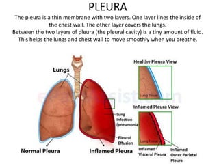 Pleurisy Pptx