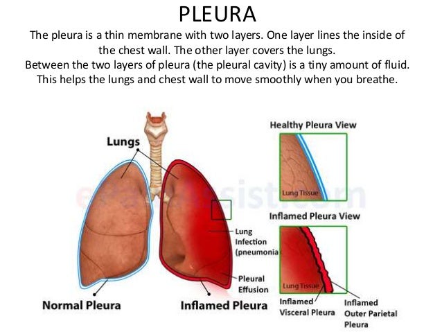Pleurisy