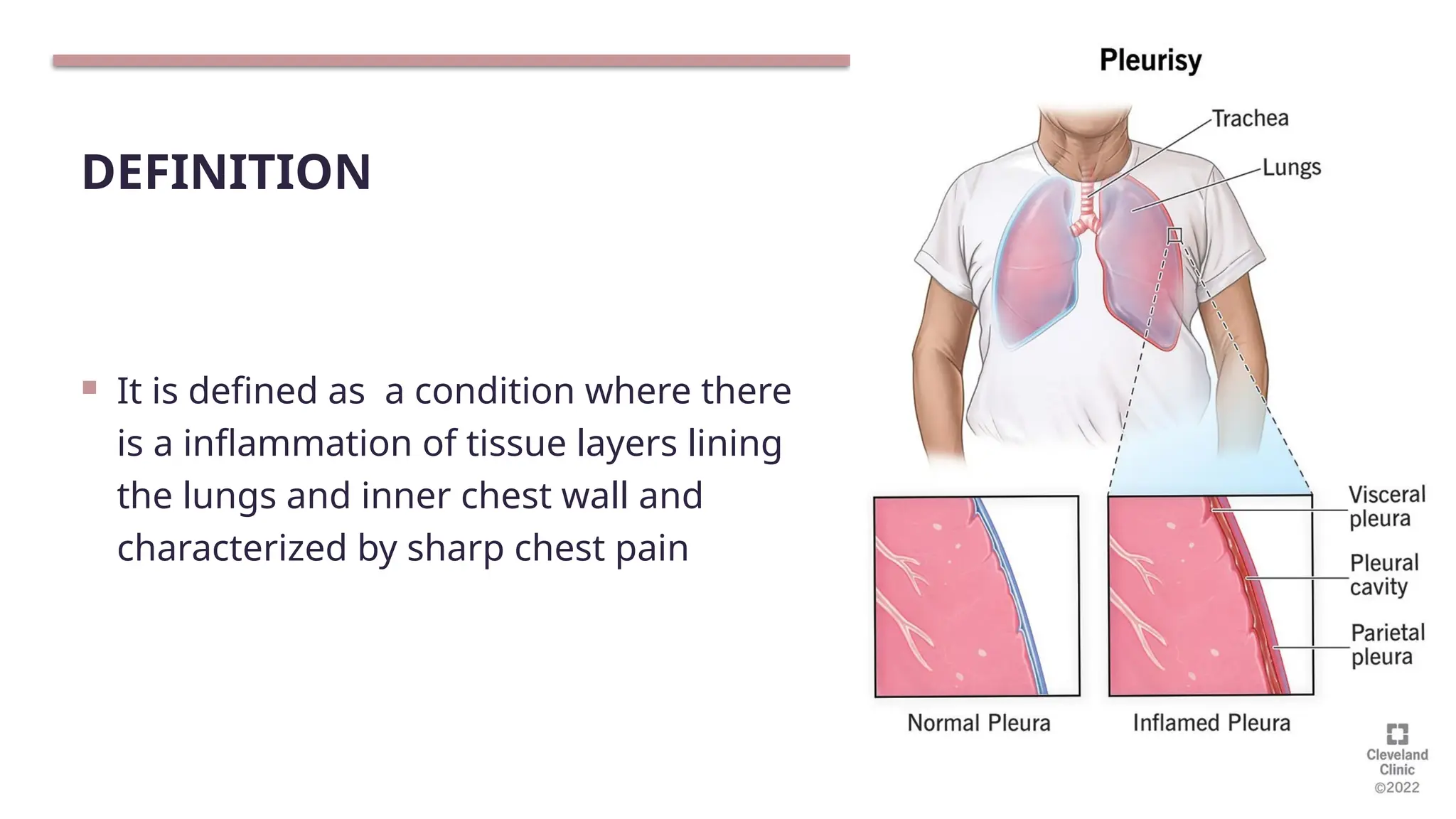 Pleurisy a short overview on this topic . | PPTX