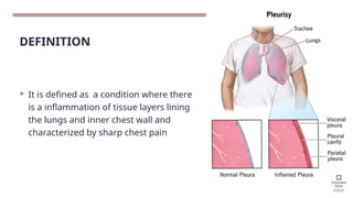 Pleurisy a short overview on this topic . | PPTX