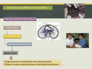 Pleuritis | PPTX