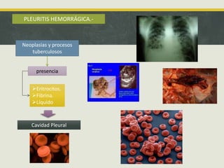 Pleuritis | PPTX