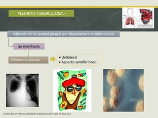 Pleuritis | PPTX