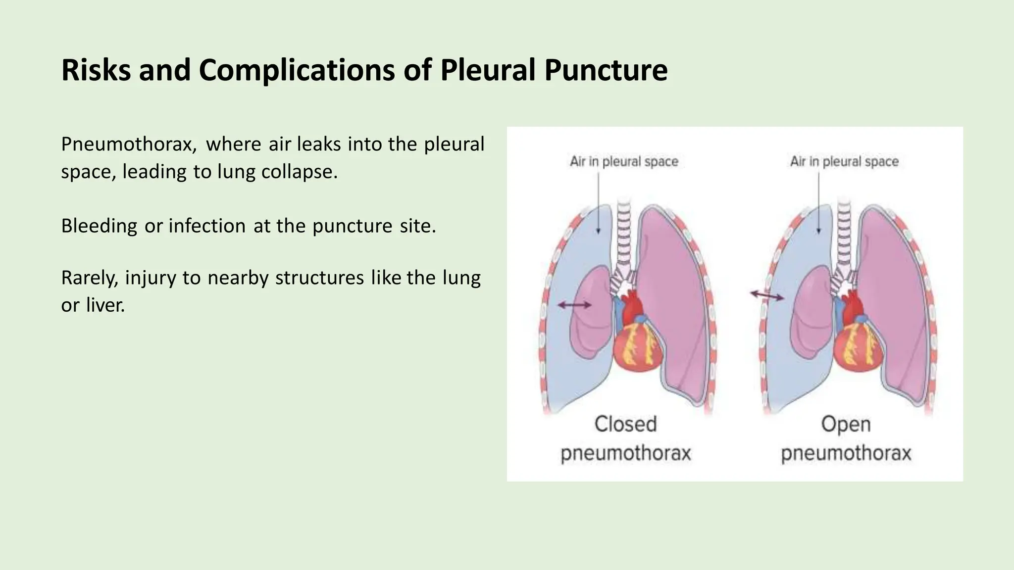 Pleuritis and pleural puncture ppt new by Tanu & Danish.pptx