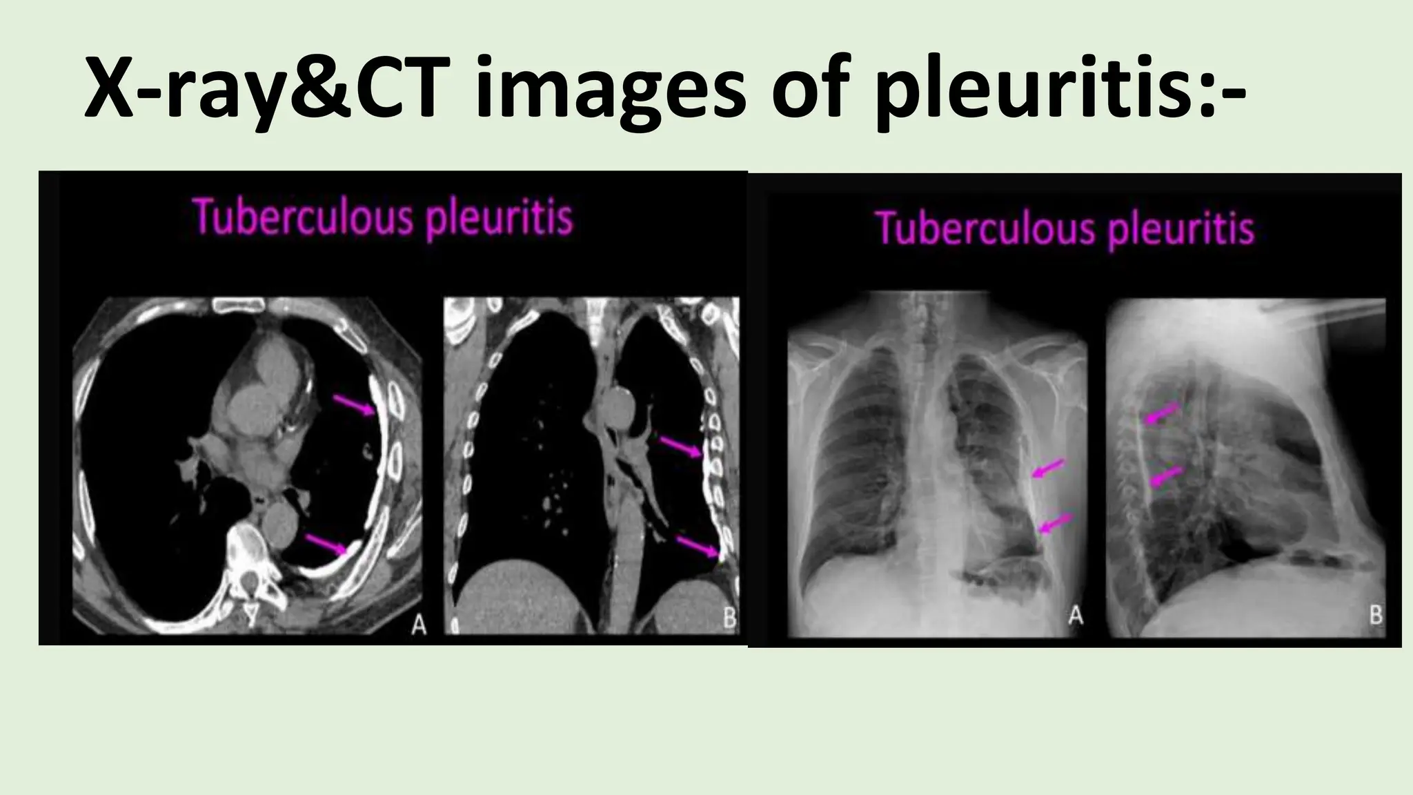 Pleuritis and pleural puncture ppt new by Tanu & Danish.pptx