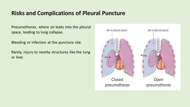 Pleuritis and pleural puncture ppt new by Tanu & Danish.pptx | Lung and ...