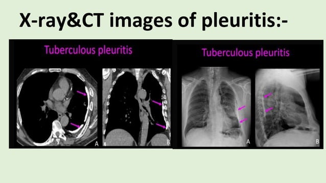 Pleuritis and pleural puncture ppt new by Tanu & Danish.pptx | Lung and ...