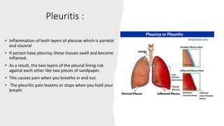 PLEURITIS . | PPTX