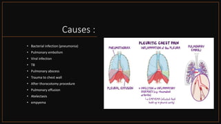 PLEURITIS . | PPTX