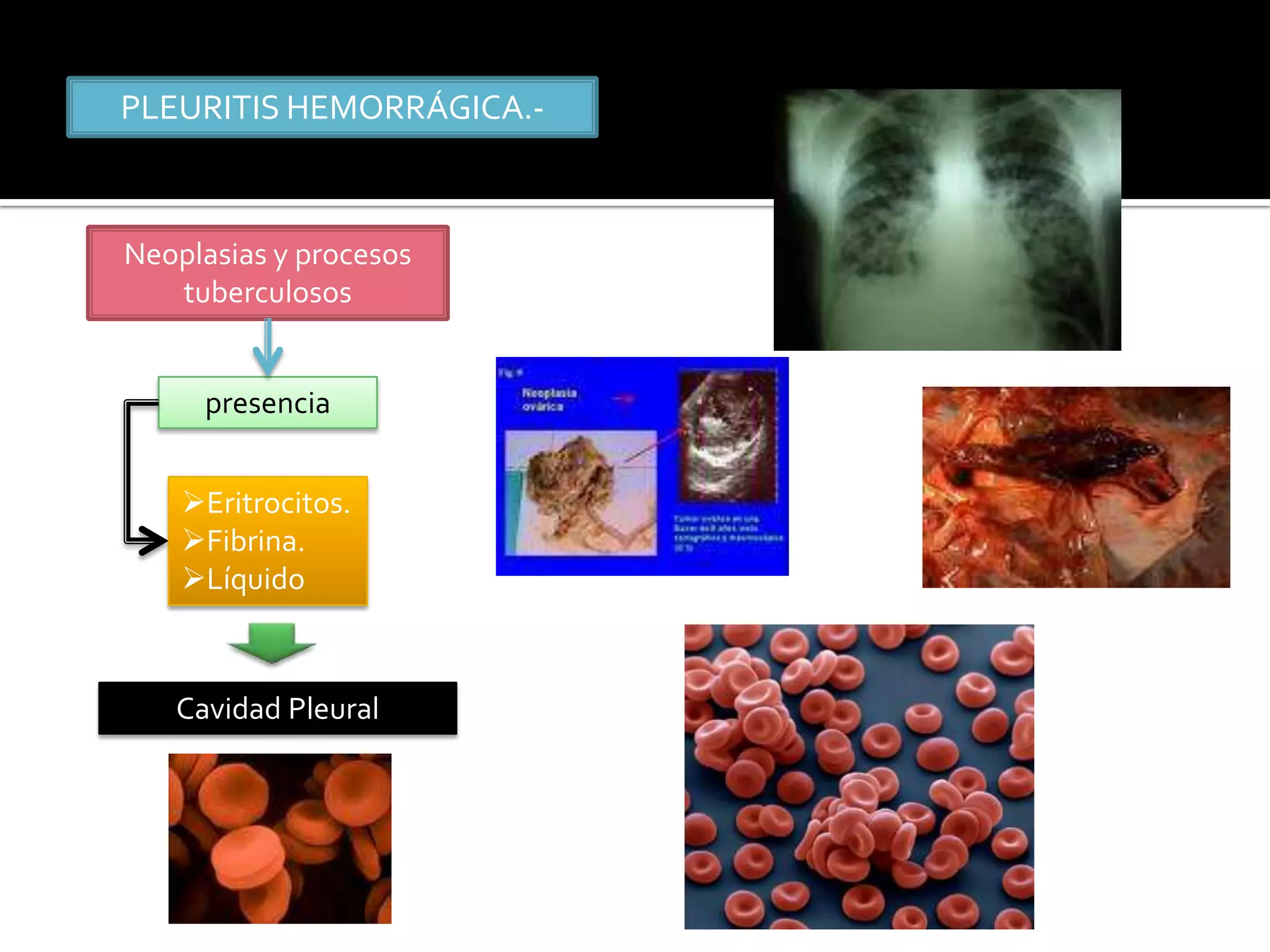 Pleuritis o pleuresía | PPTX