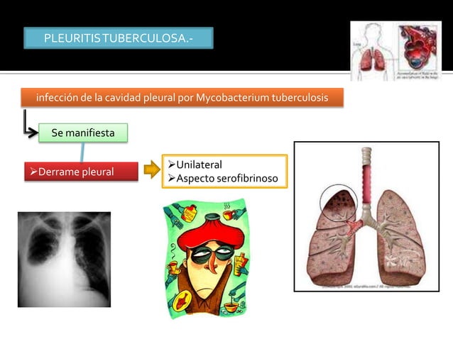 Pleuritis o pleuresía | PPTX