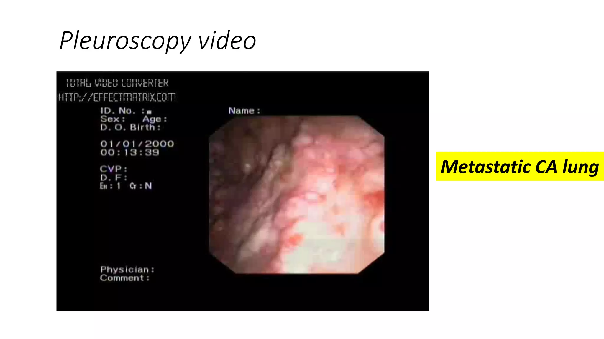 Pleuroscopy ppt by dr naseem ahmed | PPTX