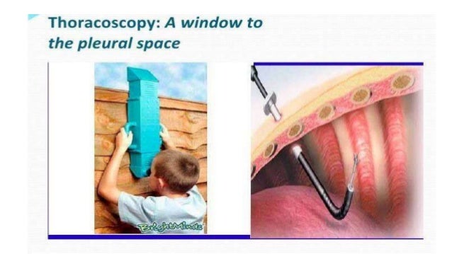 Pleuroscopy ppt by dr naseem ahmed