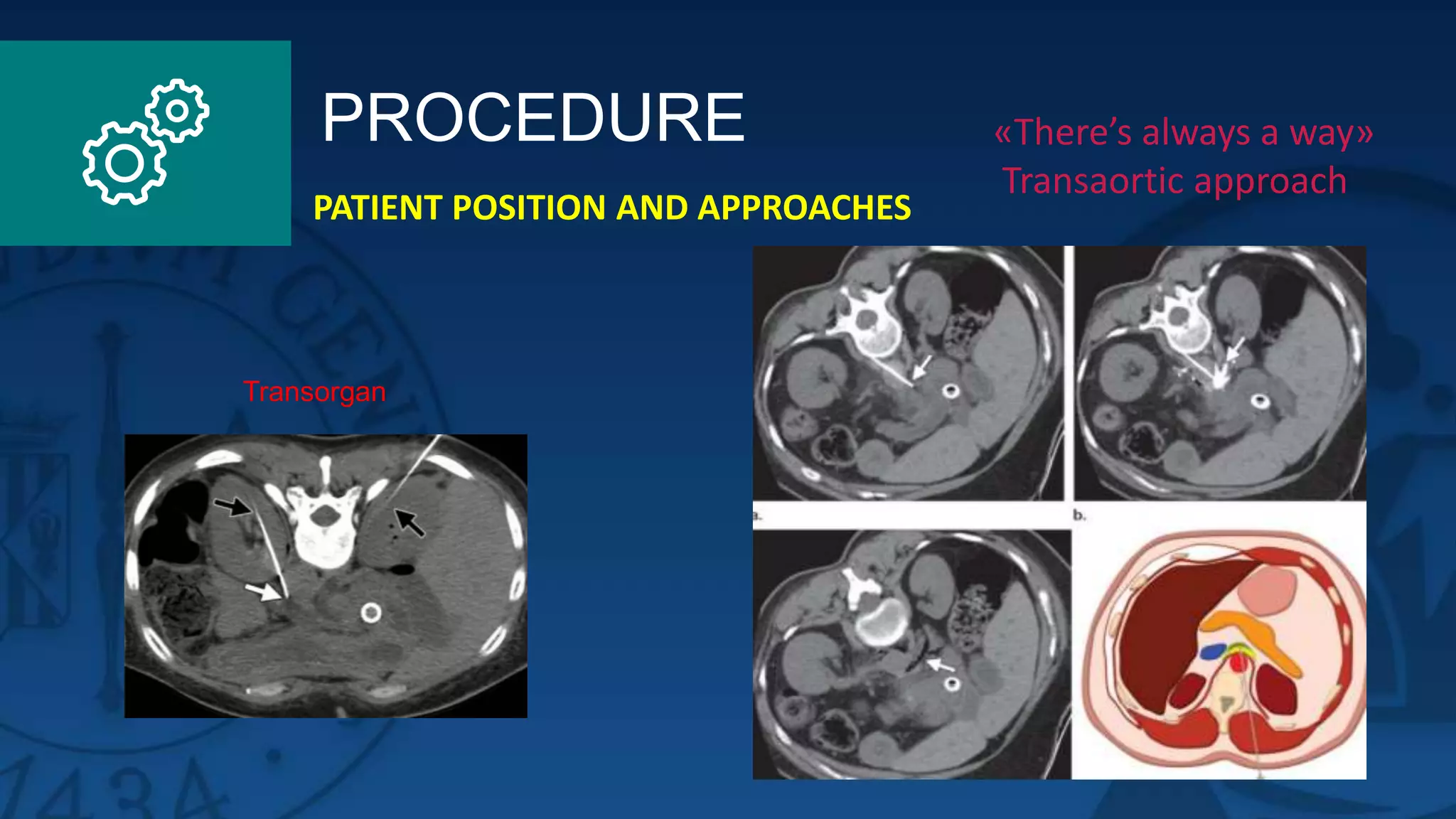 Plexus celiac neurolysis | PPTX