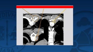 Plexus celiac neurolysis | PPTX