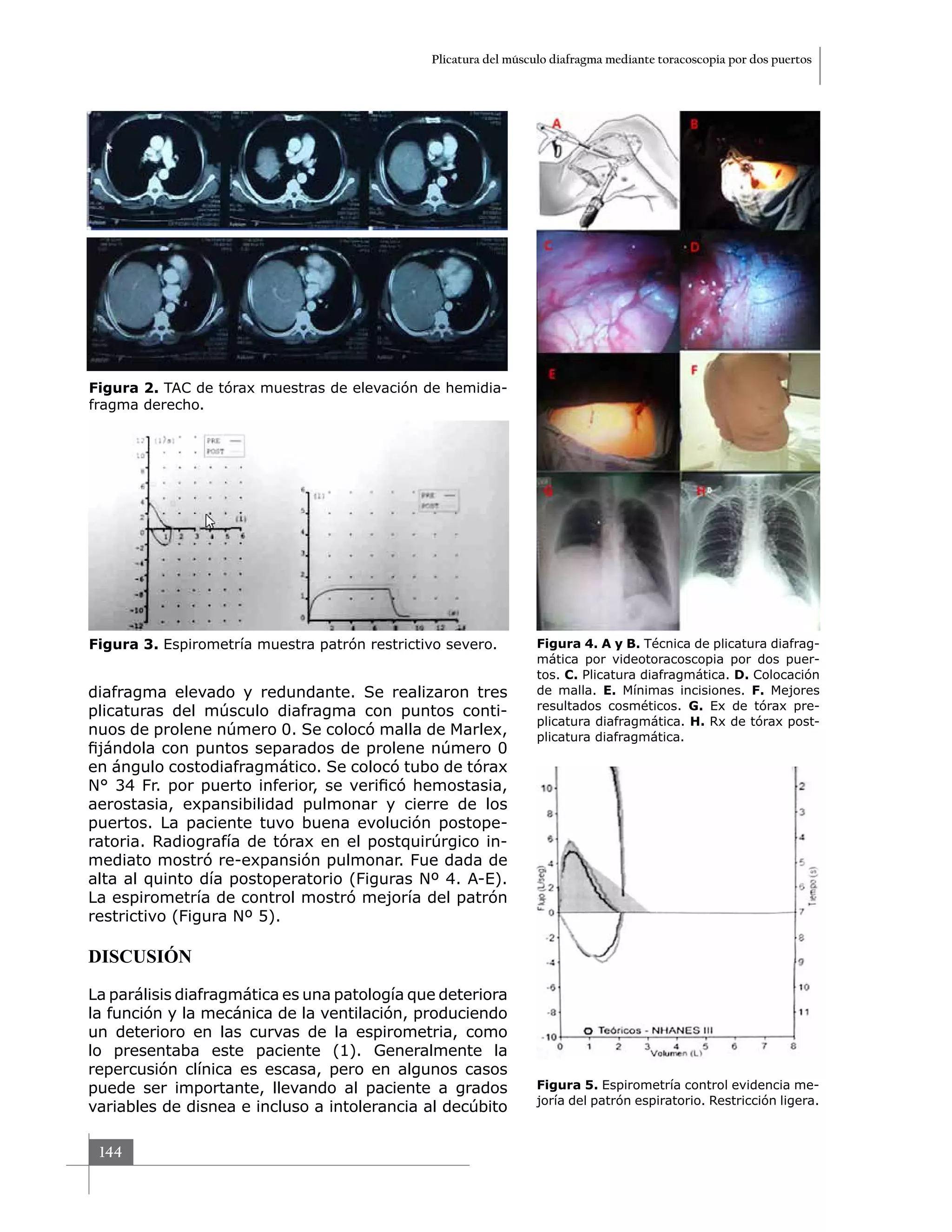 Plicatura del musculo diafragma por toracoscopia por dos puertos | PDF