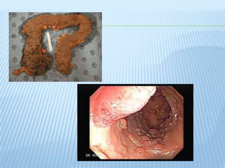 Pólipos de colon y recto
