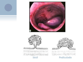 Ultrasonido De Pólipos Cervicales