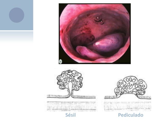 Pólipos uterinos: endometriales y endocervicales