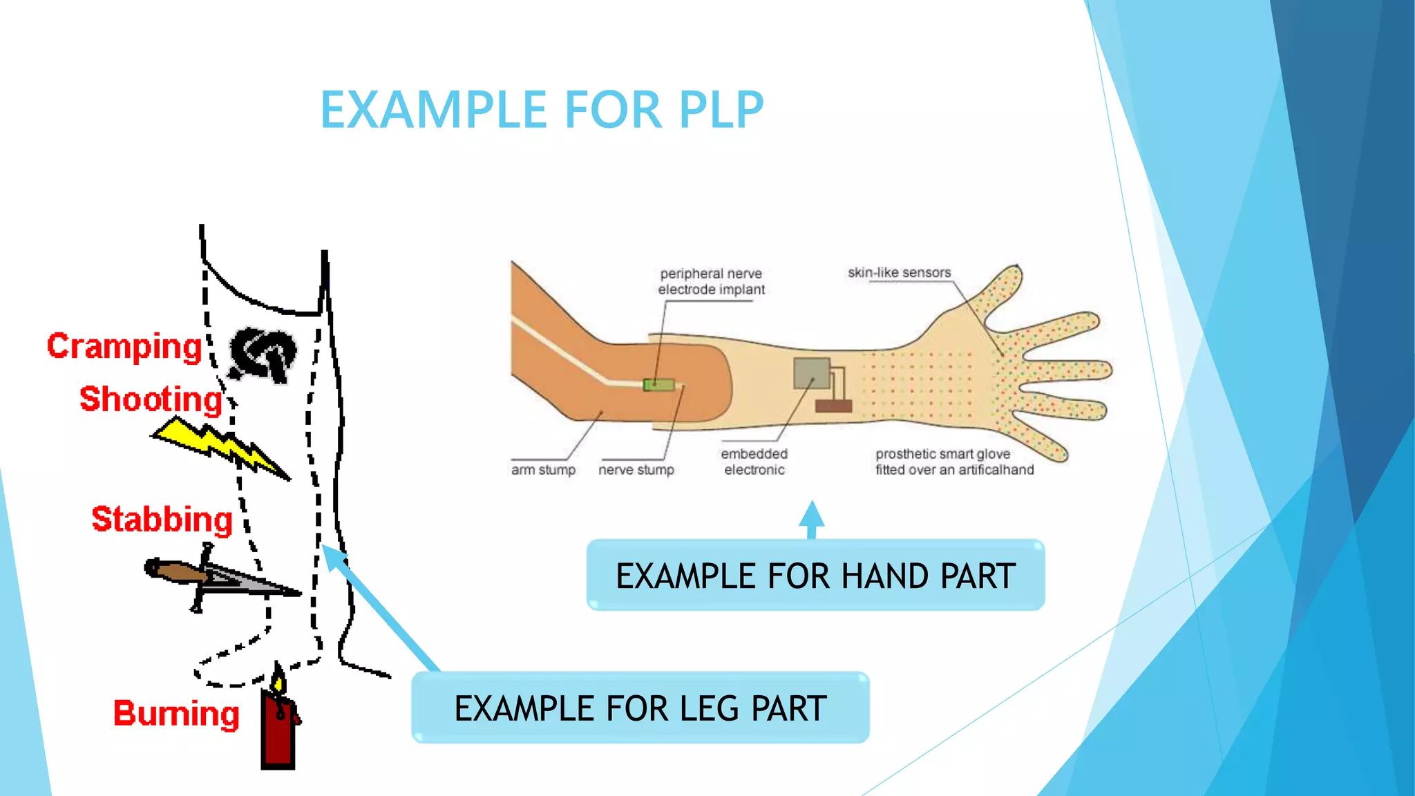 Phantom-limb Pain | PPTX