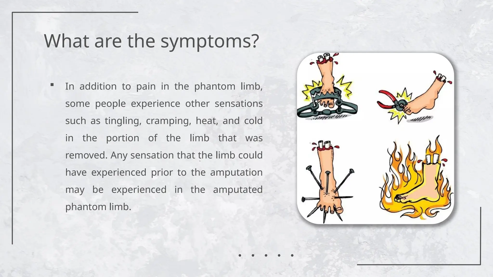 Phantom Limb Pain (PLP) | PPTX