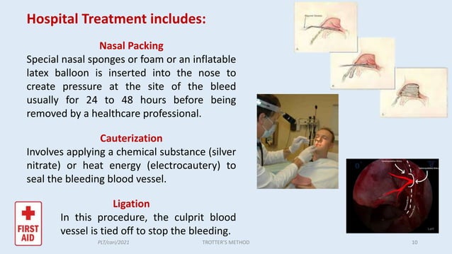 PLT Epistaxis.pptx | First Aid | Injuries