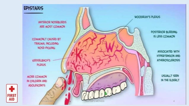 PLT Epistaxis.pptx | First Aid | Injuries
