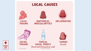 PLT Epistaxis.pptx
