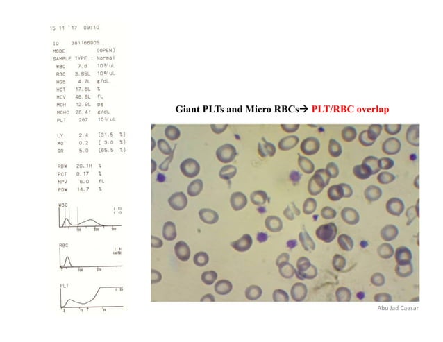 Platelets Histogram | PDF