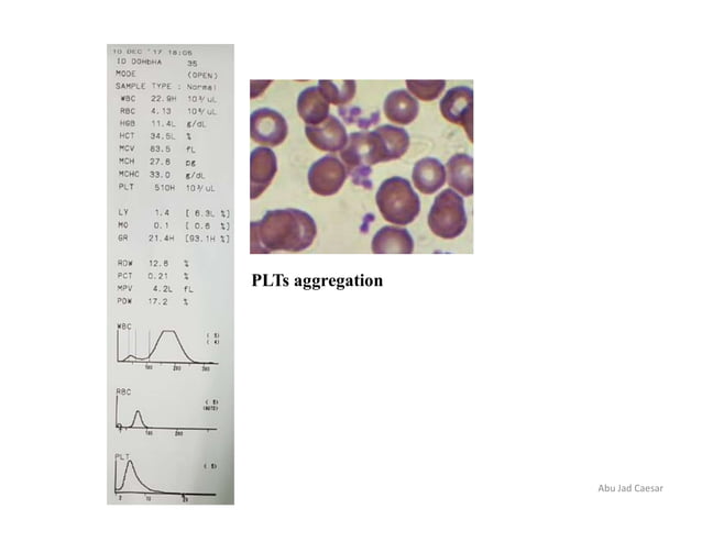 Platelets Histogram