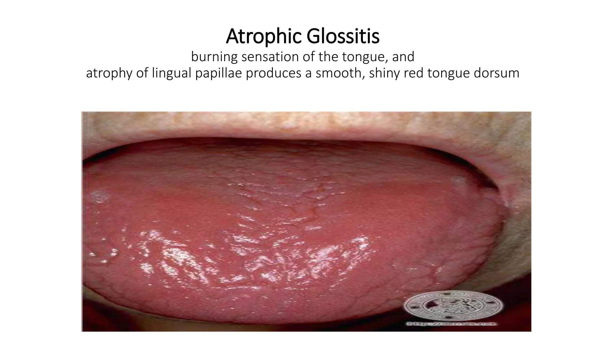 Plummer Vinson Syndrome | PPTX