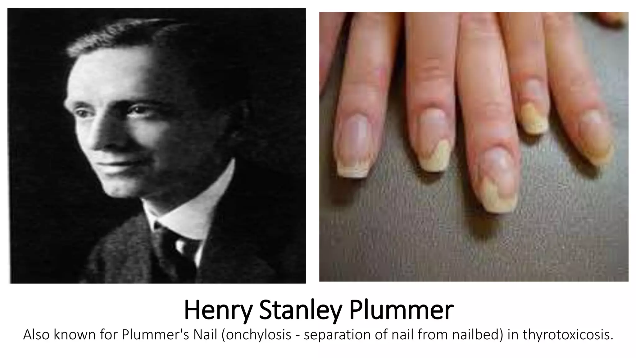 Plummer Vinson Syndrome | PPTX