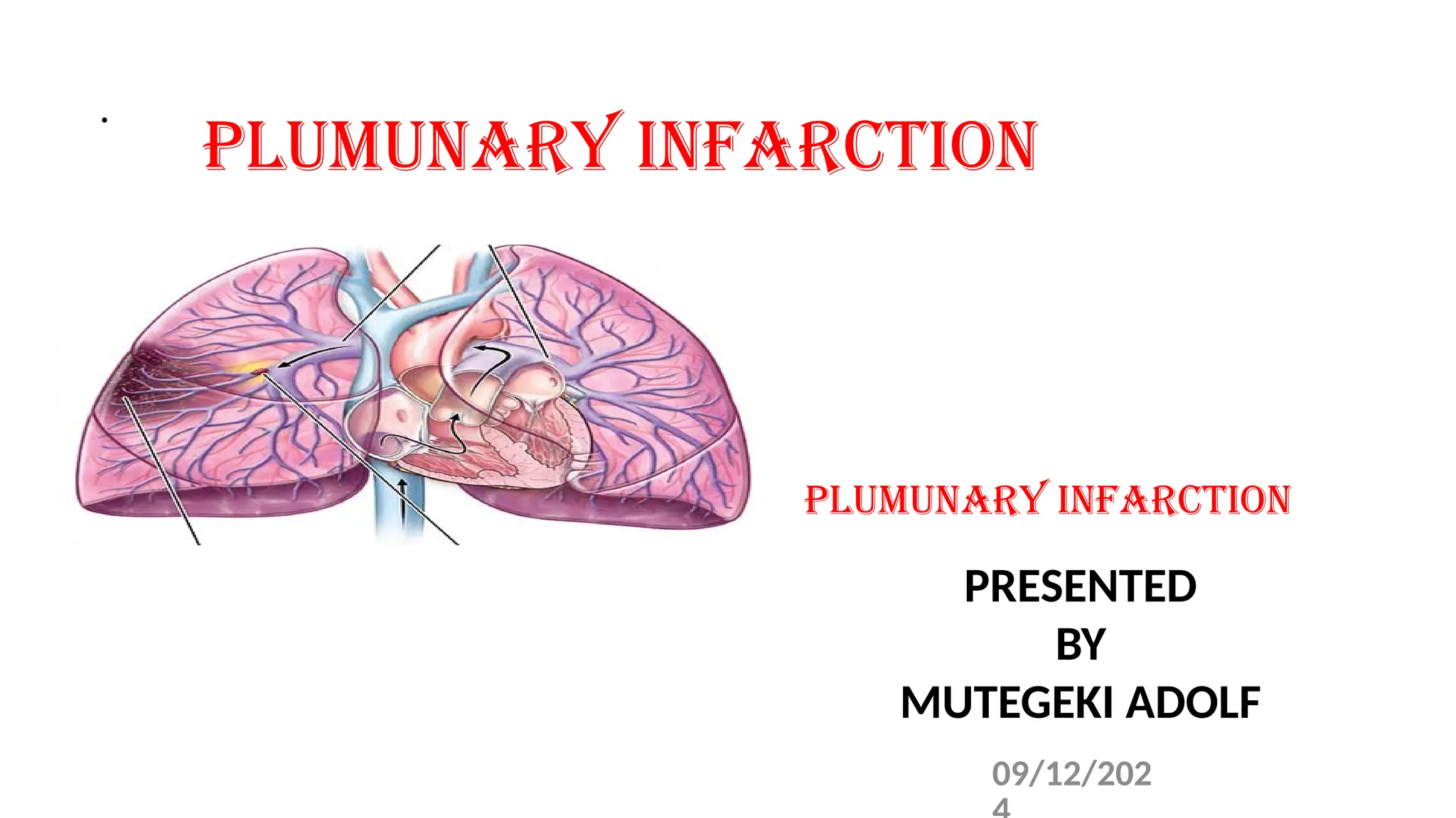 Plumunary Infarction.pptx DEATH OF PART OF LUNG | PPTX