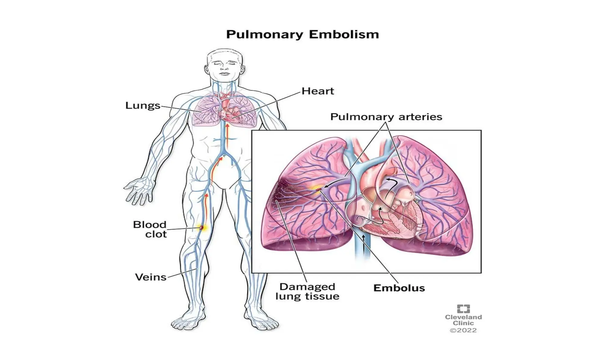 Plumunary Infarction.pptx DEATH OF PART OF LUNG | PPTX
