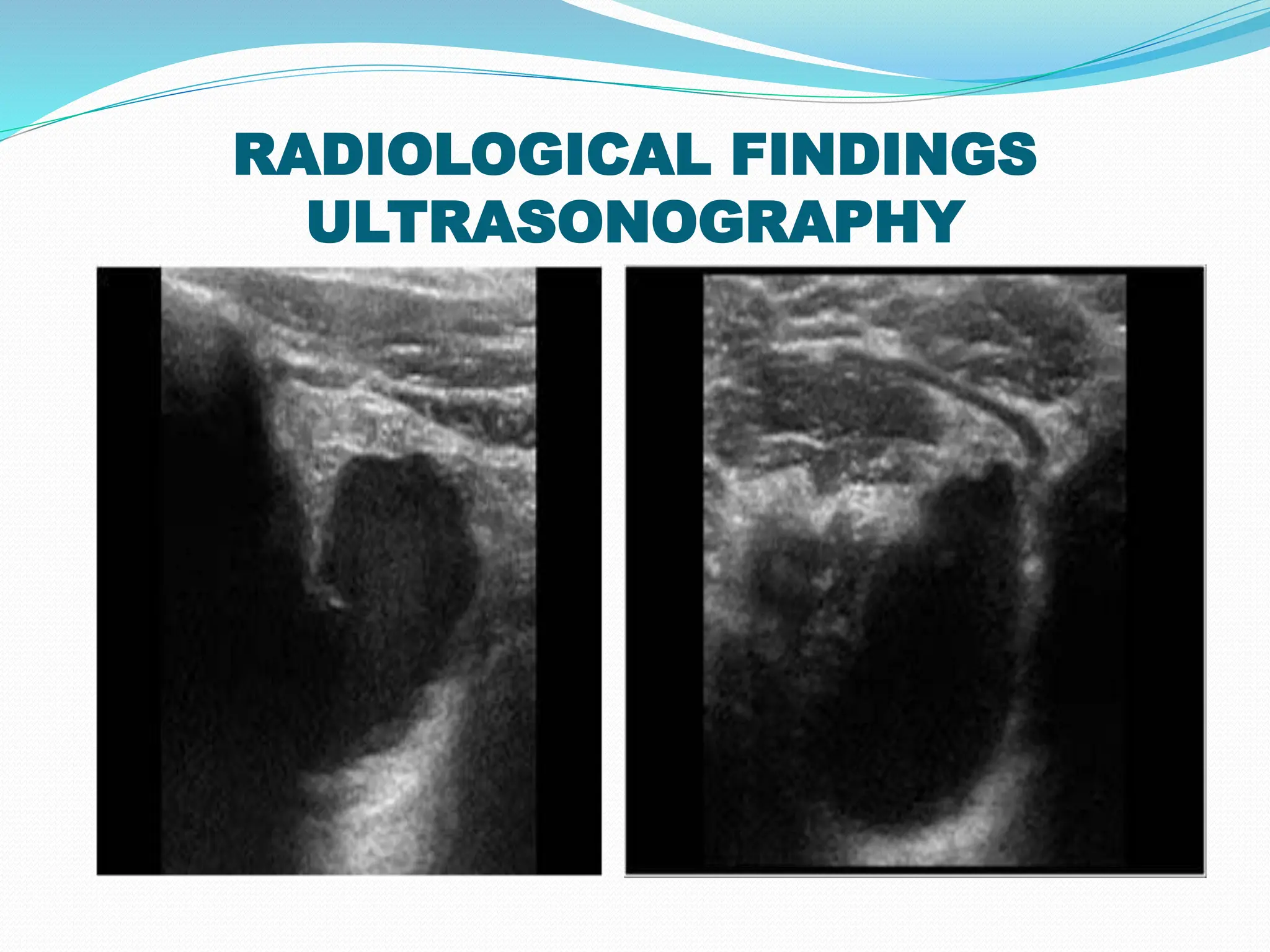 PLUNGING RANULA- A CASE REPORT.(Deep, diving or a cervical ranula) | PPTX
