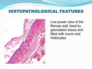 PLUNGING RANULA- A CASE REPORT.(Deep, diving or a cervical ranula) | PPTX