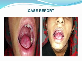 PLUNGING RANULA- A CASE REPORT.(Deep, diving or a cervical ranula) | PPTX