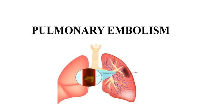 Plural effusion, PE & lung abscess, pneumothorax_014402.pptx