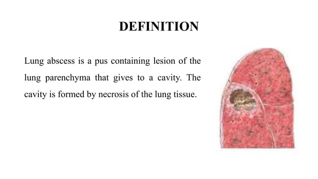 Plural effusion, PE & lung abscess, pneumothorax_014402.pptx