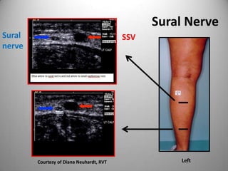The Important Nerves During Venous Ablation | PDF