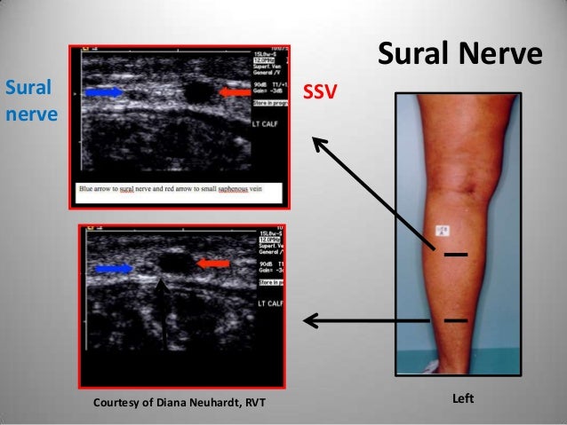 The Important Nerves During Venous Ablation