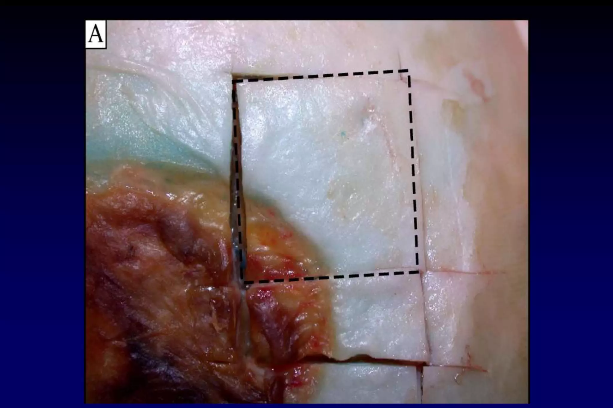 Thigh, Calf & Ankle Perforators: Are They Different? | PDF