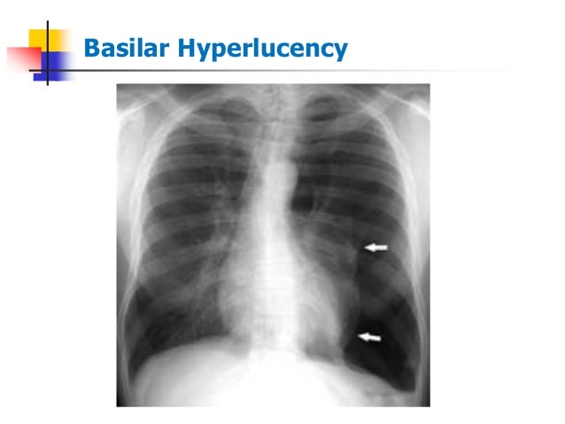 Pm34 胸部x線写真の読影⑤
