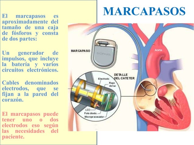 marcapasos en biomedica | PPT