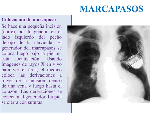 marcapasos en biomedica | PPTX